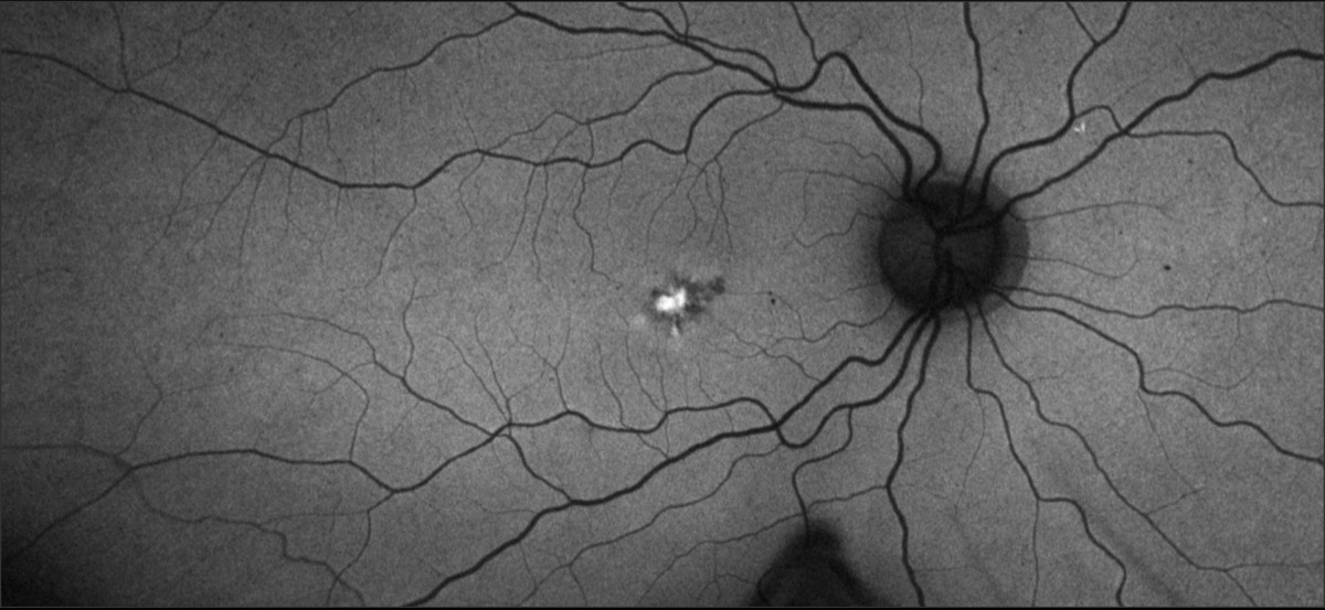 About Adult Vitelliform Dystrophy | Retina Doctor Melbourne