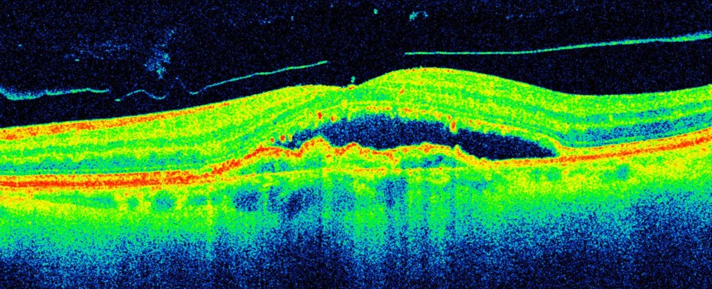 AMD CNV OCT 2 - Retina Doctor