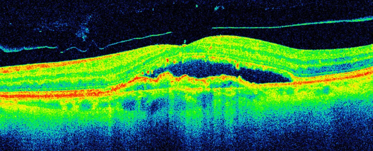 AMD CNV OCT 2 - Retina Doctor