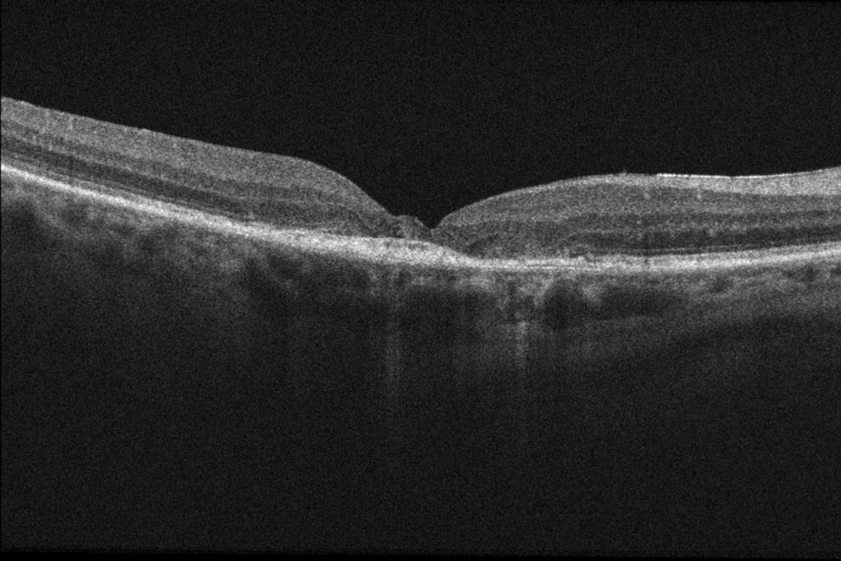 Age-related Macular Degeneration Treatments | Retina Doctor Melbourne