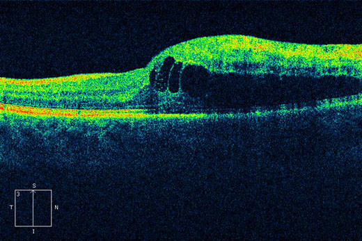 BRVO-OCT - Retina Doctor