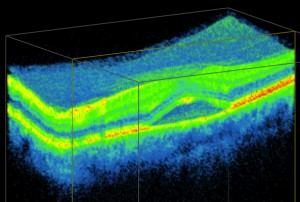 Central Serous Chorioretinopathy (CSCR or CSR) | Retina doctor Melbourne