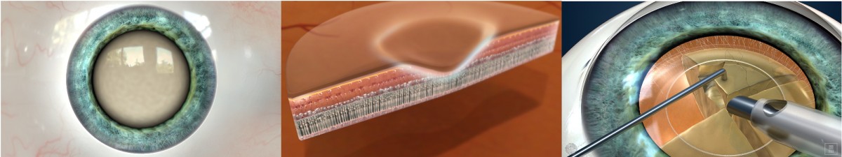 Combined Vitrectomy and Cataract Surgery info & FAQ's