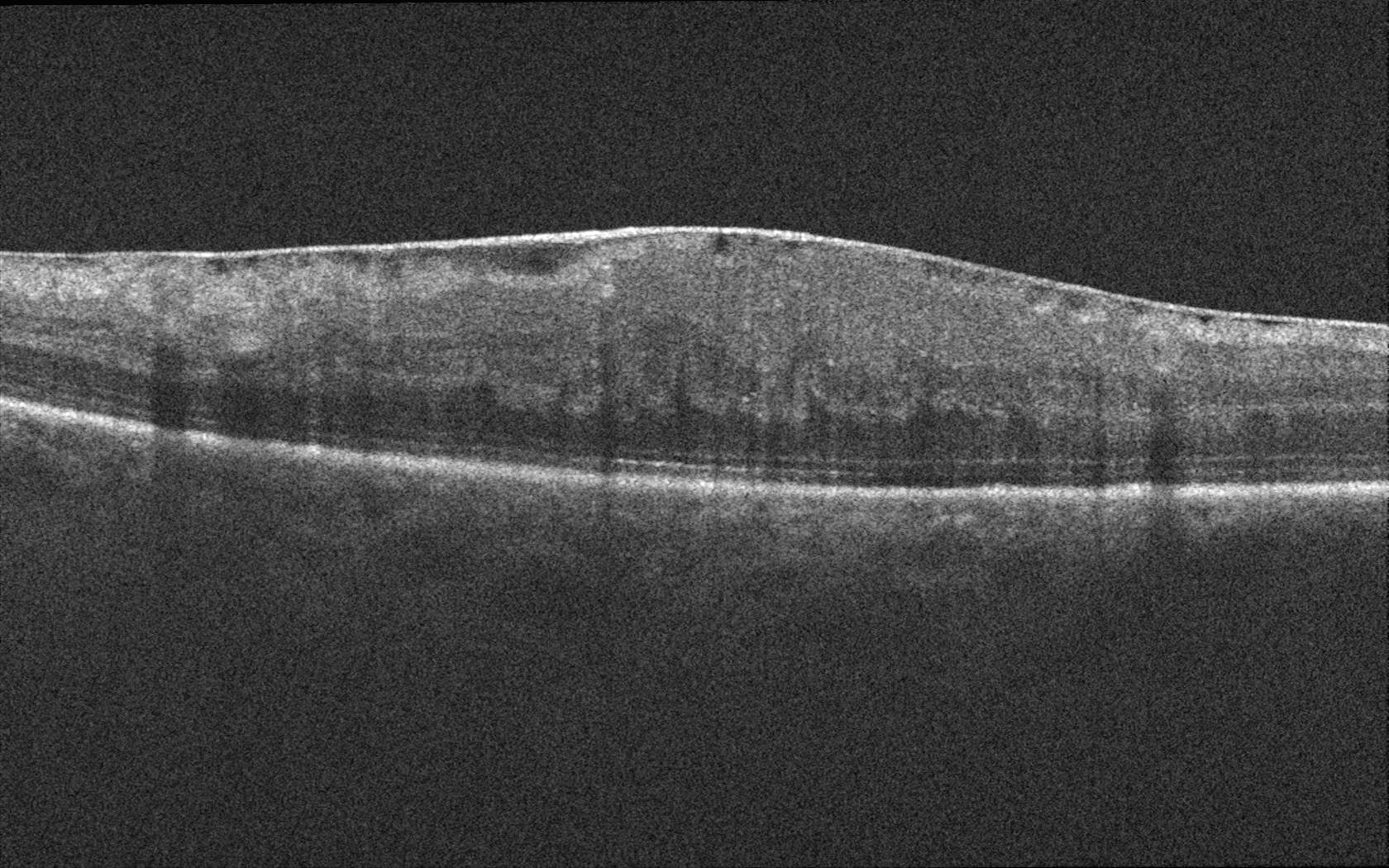 ERM OCT 2 - Retina Doctor