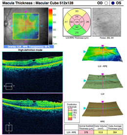 ERM-OCT.tiff - Retina Doctor