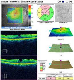 ERM-pseudohole-OCT.tiff - Retina Doctor