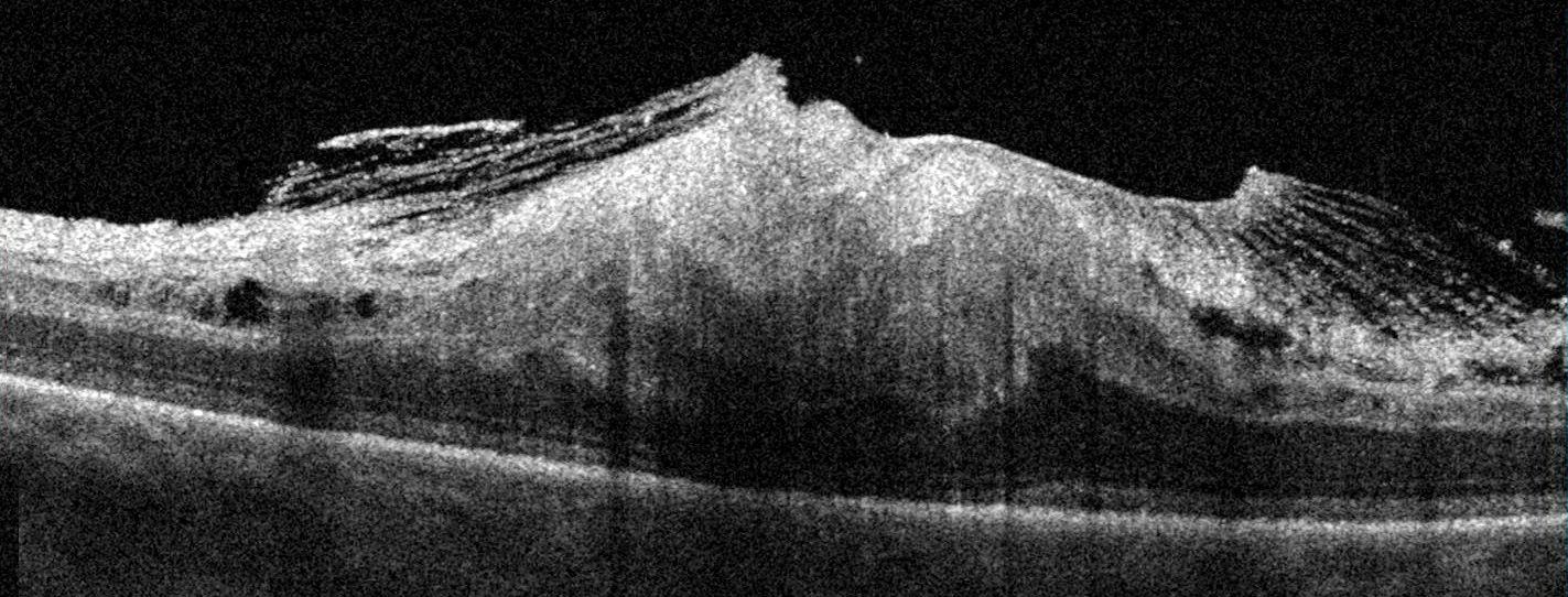 Epiretinal Membrane | Retina Doctor Melbourne
