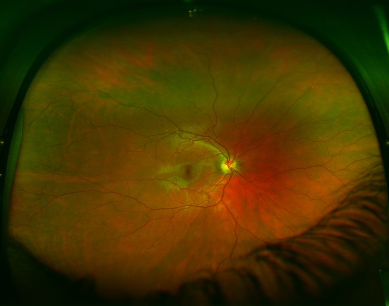 Wide Field Retinal Photography | Retina Doctor Melbourne
