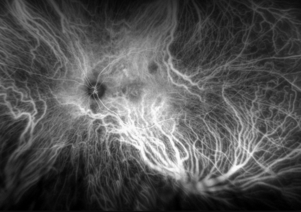 Fluorescein and ICG angiograms - Retina Doctor Melbourne