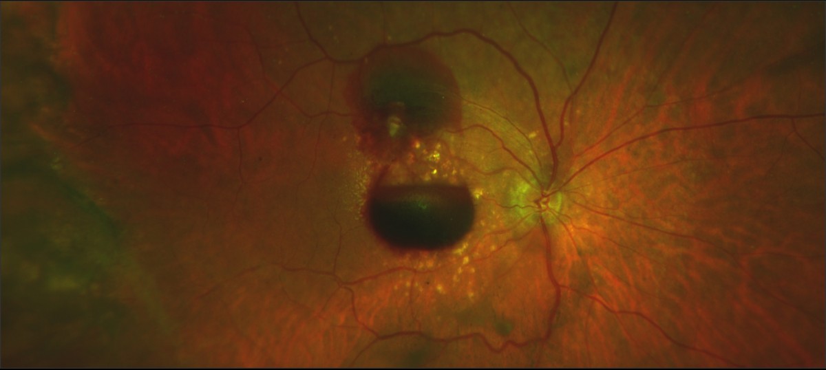 Best Treatment for Retinal Macroaneurysm | Retina doctor Melbourne