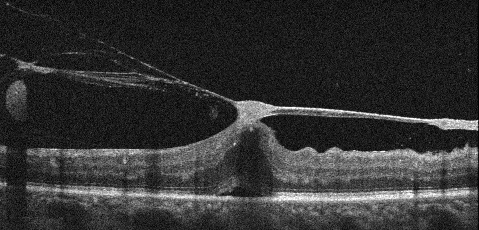 Vitreomacular Traction Treatment VITREOMACULAR TRACTION (VMT)