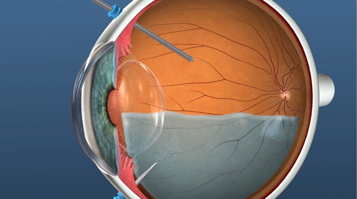 Post Vitrectomy Recovery and Posturing - Retina Doctor