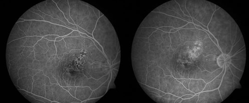 Retinal Vein Occlusion | Information & FAQ | Retina Doctor Melbourne