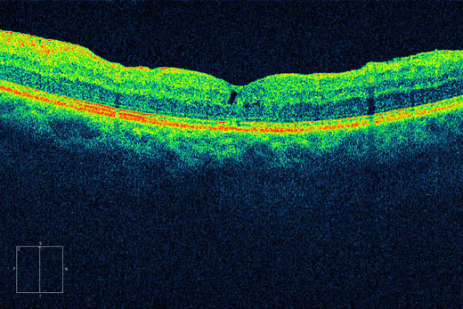 Macular Hole Condition and treatment | Retina Doctor Melbourne