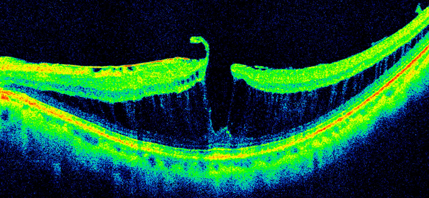 VMT colour OCT - Retina Doctor