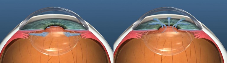 The Aqueous Humour | Retina Doctor Melbourne