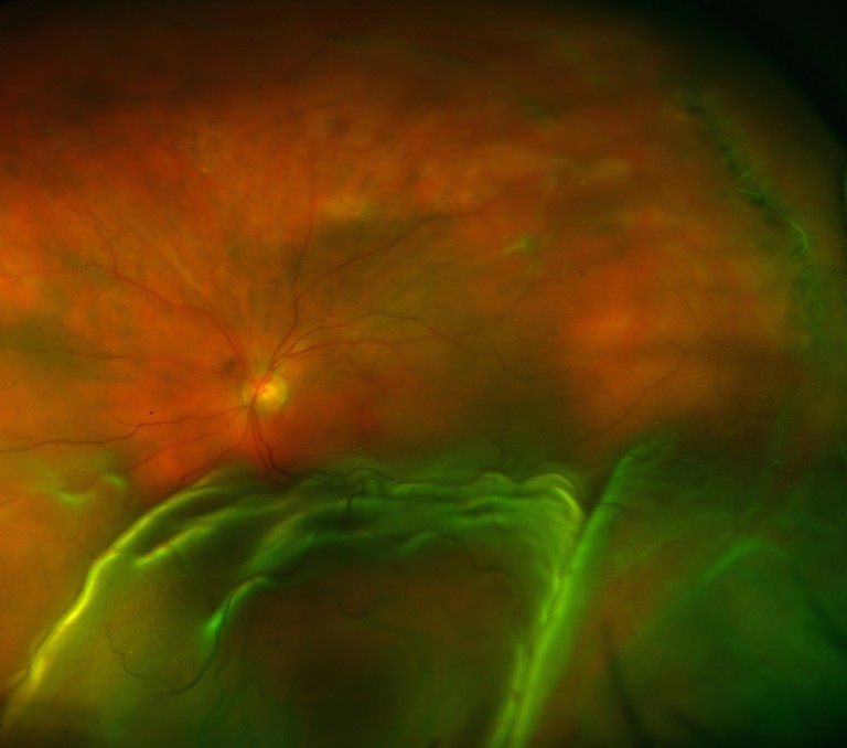 Cryo-Buckle Surgery for Retinal Detachment | Retina Doctor Melbourne