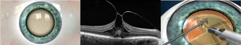 Combined Surgery for Vitreomacular Traction Syndrome - Retina Doctor
