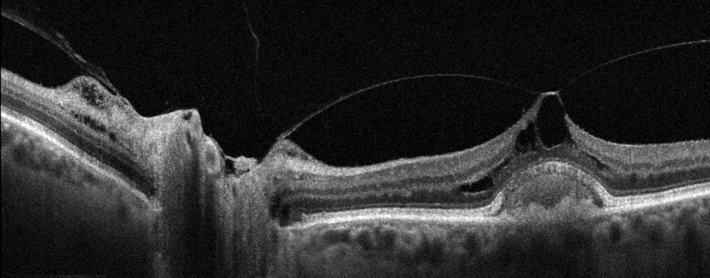 VFT wide - Retina Doctor