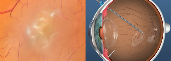 3. Vitrectomy for epiretinal membrane - Retina Doctor