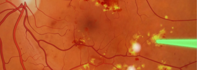 22. Retinal laser treatment - Retina Doctor